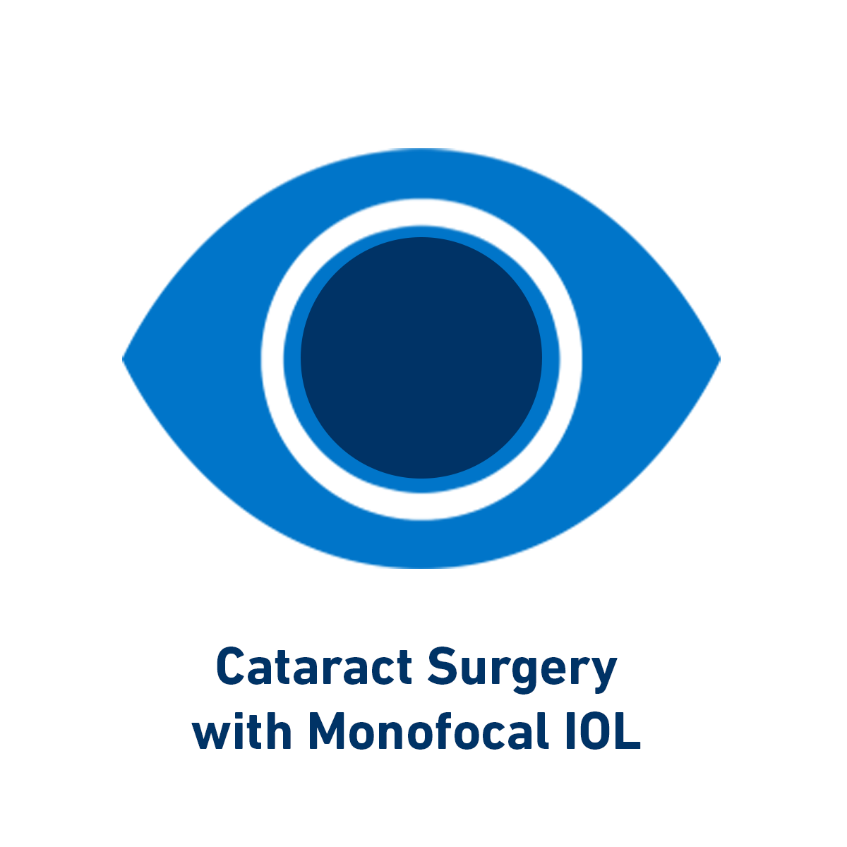Cataract Surgery with Monofocal IOL – CODET Vision Institute